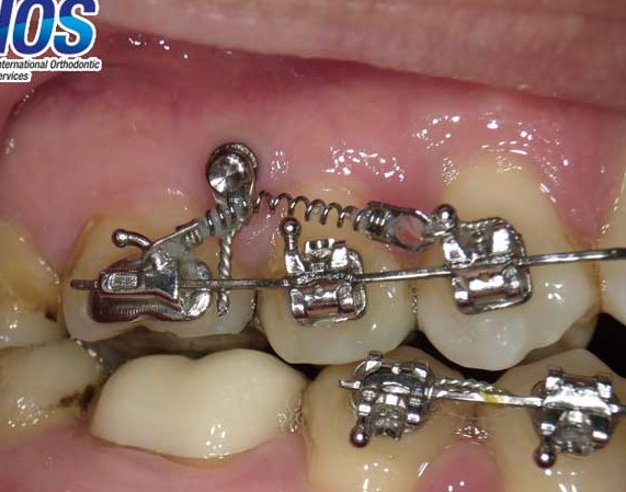 Orthodontic Closed Coil NiTi Springs Eyelets (12mm, Medium) - IOS